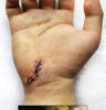 Self-Surgery in The Field | TRDCRFT
